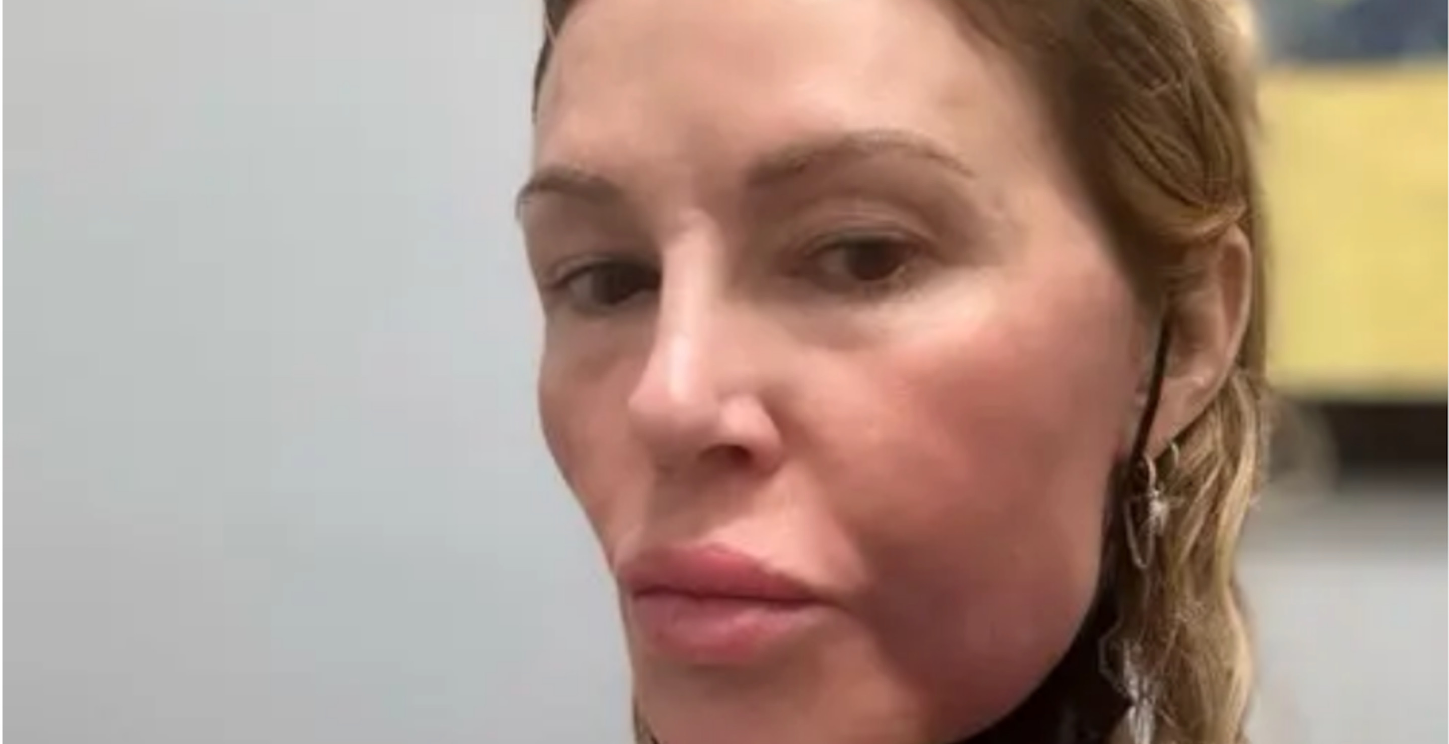 Brandi Glanville Reveals Facial Disfigurement Has Affected Love Life ...